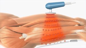 TECAR Therapy - Asian Orthopedics